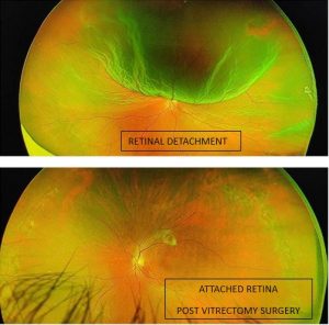 Blog Rhegmatogenous Retinal Detachment – Prime Retina Eye Care Centre