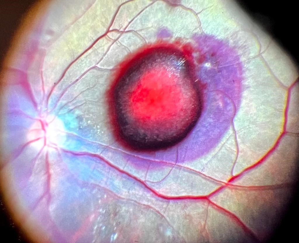Blog Ruptured Retinal Artery Macroaneurysm - Prime Retina Eye Care ...