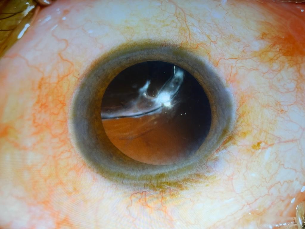 Blog Intraocular Lens Dislocation - Prime Retina Eye Care Centre - Best ...