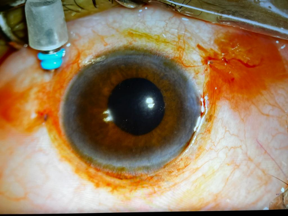 Blog Intraocular Lens Dislocation - Prime Retina Eye Care Centre - Best ...