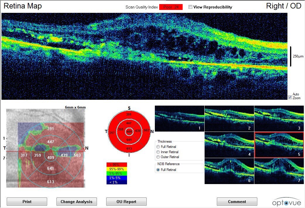 Blog Choroidal Neovascular Membrane - Prime Retina Eye Care Centre ...