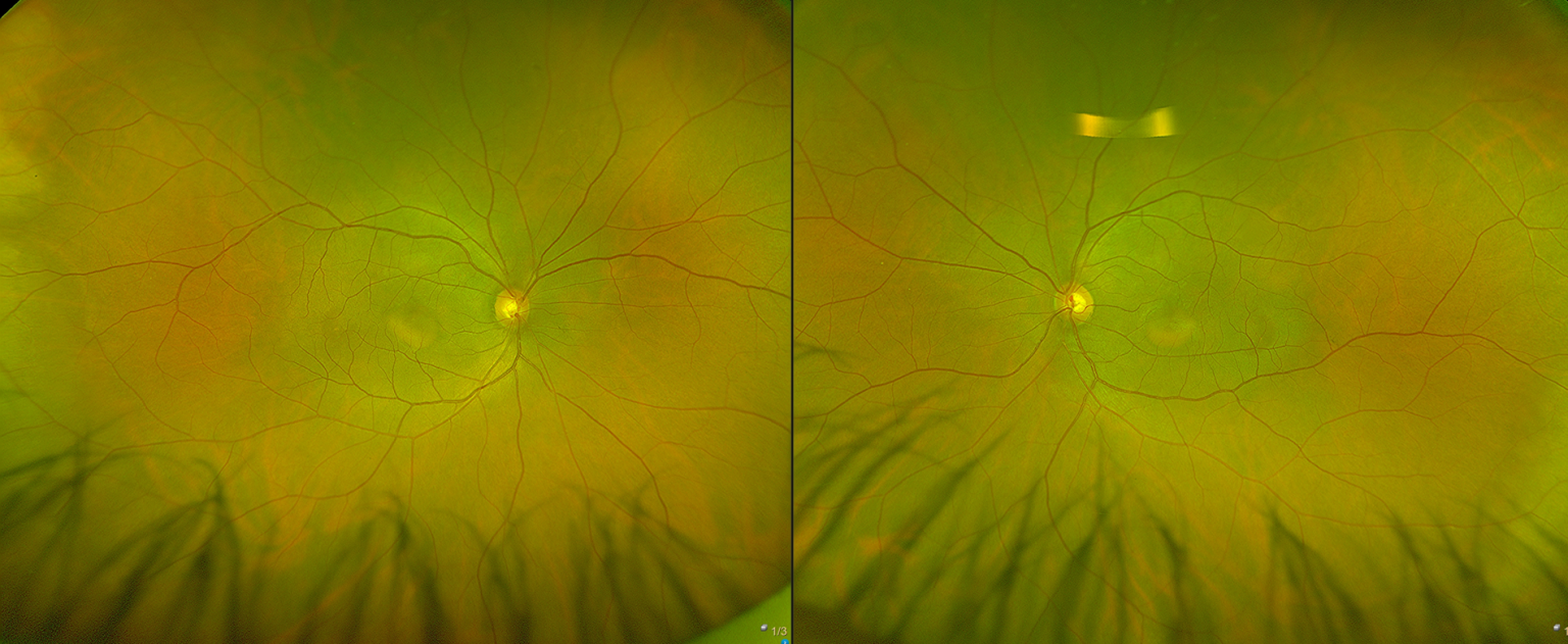 Blog Adult Onset Vitelliform Dystrophy - Prime Retina Eye Care Centre ...