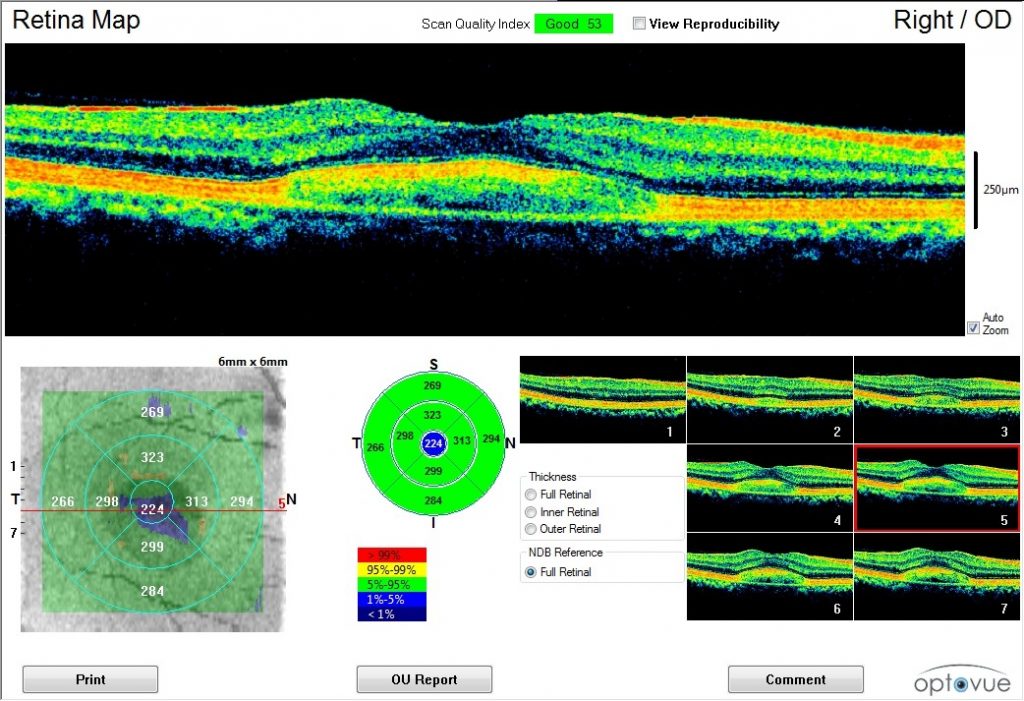Blog Adult Onset Vitelliform Dystrophy - Prime Retina Eye Care Centre ...