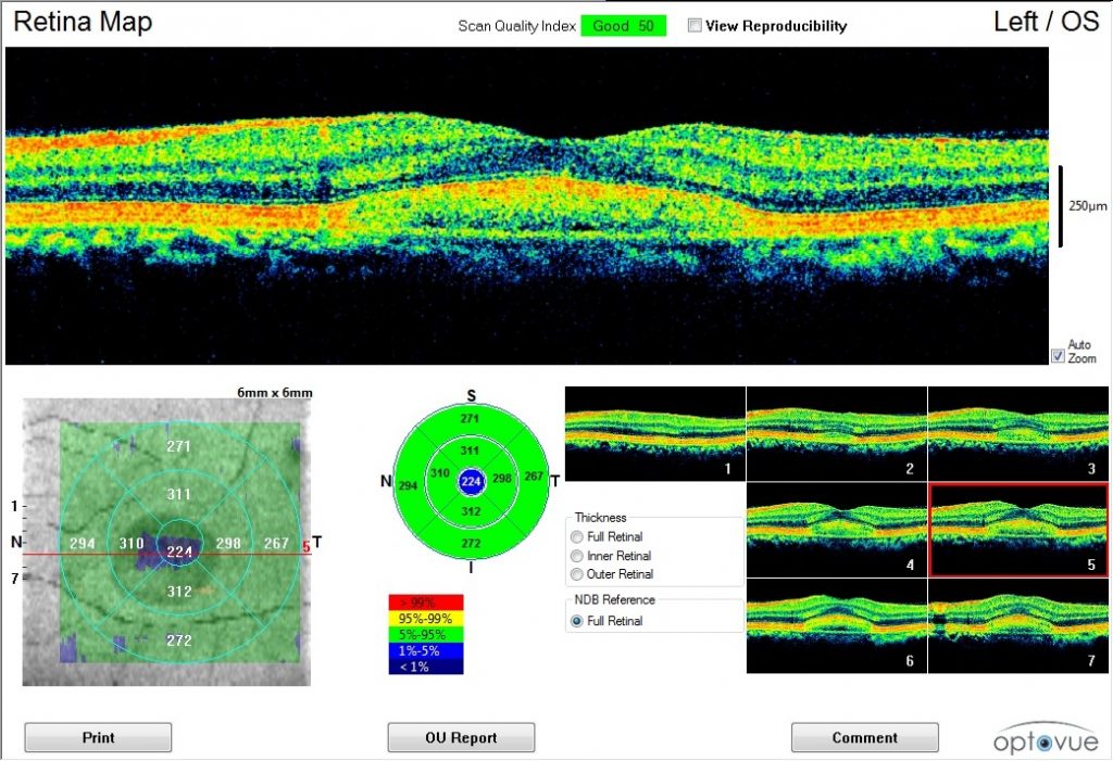 Blog Adult Onset Vitelliform Dystrophy - Prime Retina Eye Care Centre ...