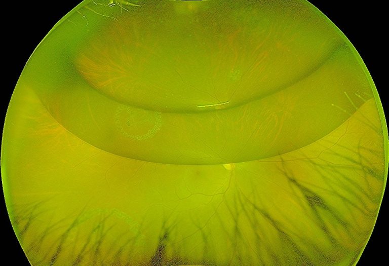 Blog Retinal Detachment - Prime Retina Eye Care Centre - Best Eye ...
