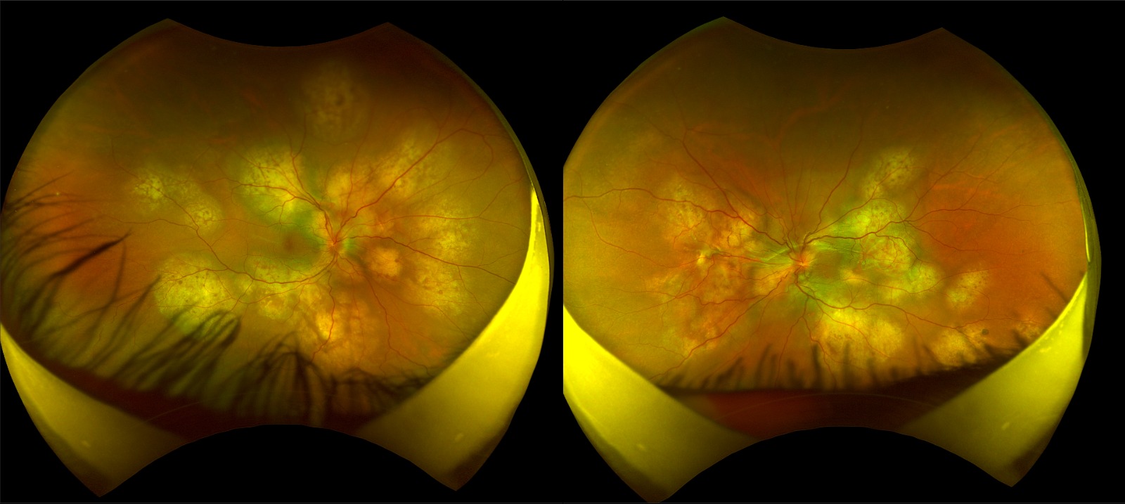 Blog Choroidal Metastasis - Prime Retina Eye Care Centre